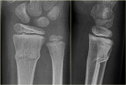 SGEM#19: Bust-a-Move (Buckle and Greenstick Fractures) | The Skeptics ...