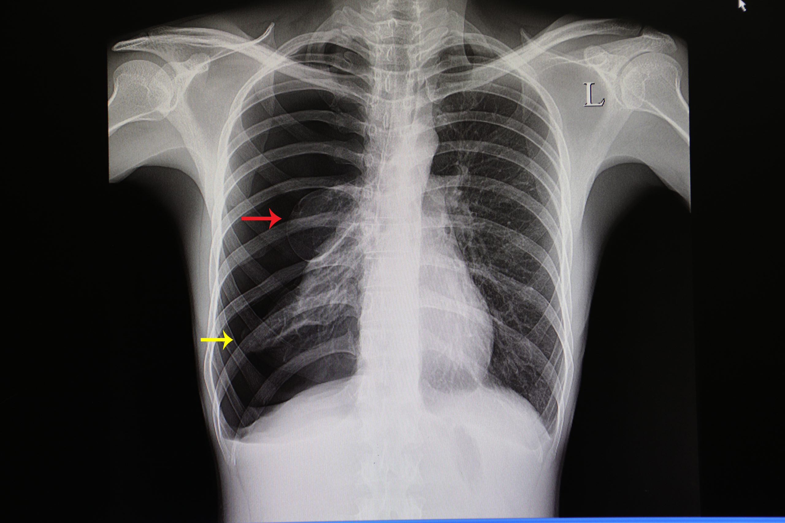 SGEM#300: The Lung is Up Where it Belongs – With or Without a Chest ...